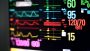 Auscultation of Atrial Fibrillation: A Detailed Guide - Stethoscope